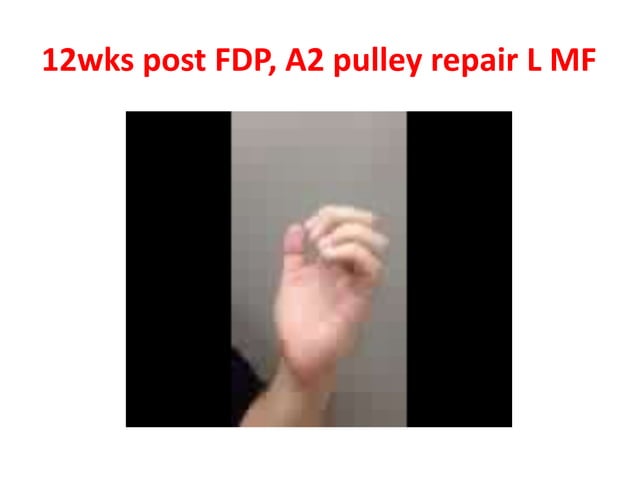 Flexor tendon rehabilitation zone II | PPTX | Death, Injury, or ...