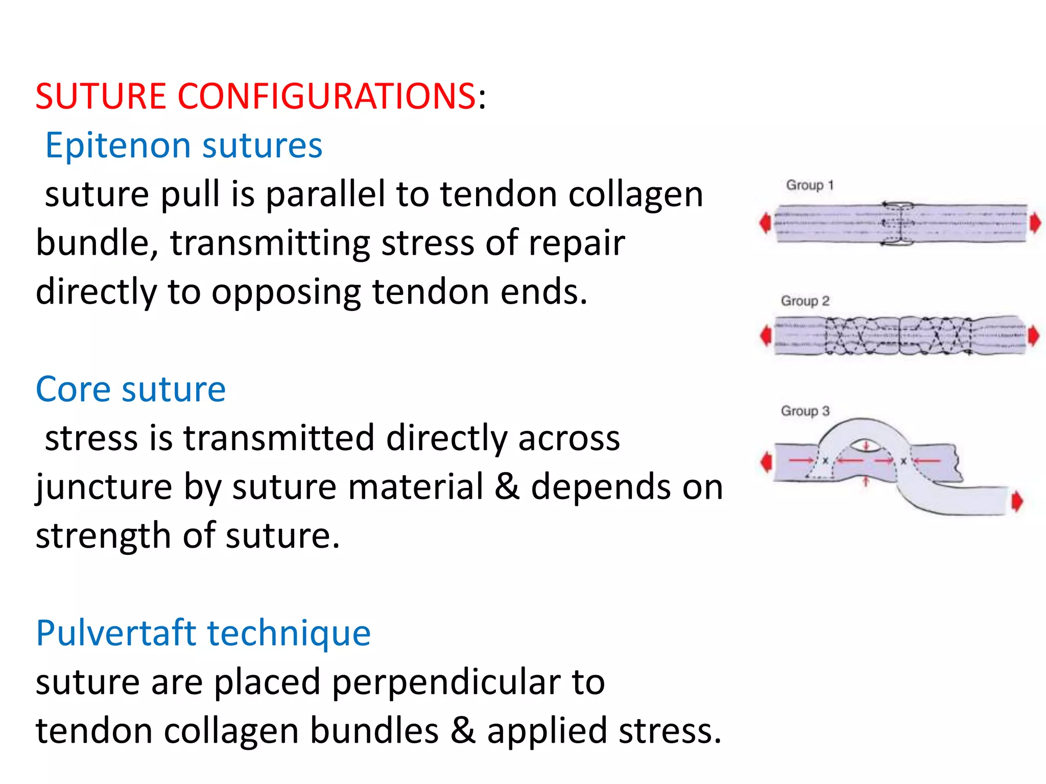 Flexor tendon repair | PPTX