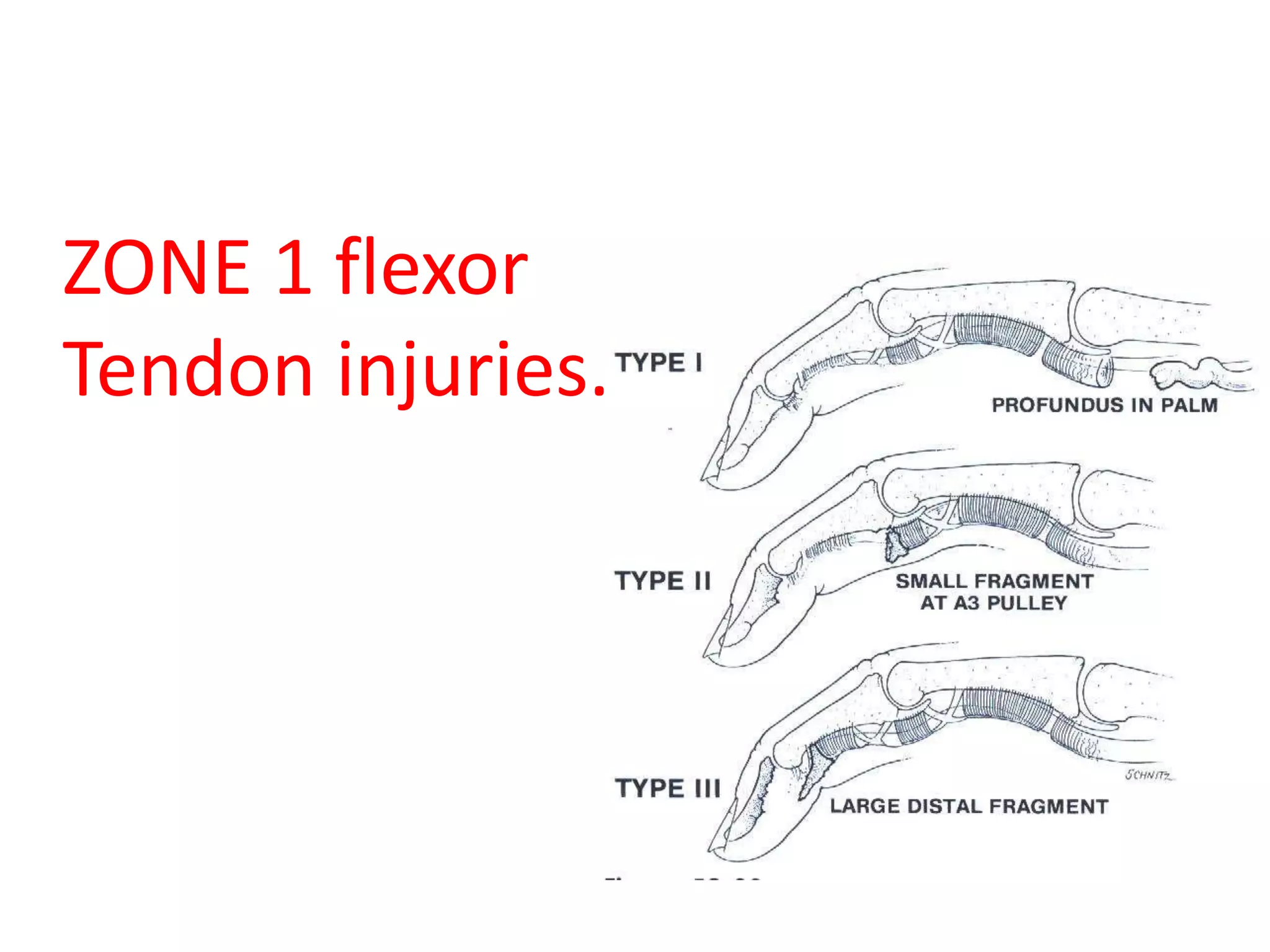 Flexor tendon repair | PPTX