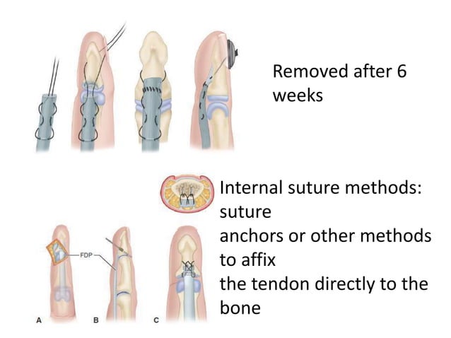 Flexor tendon repair | PPTX