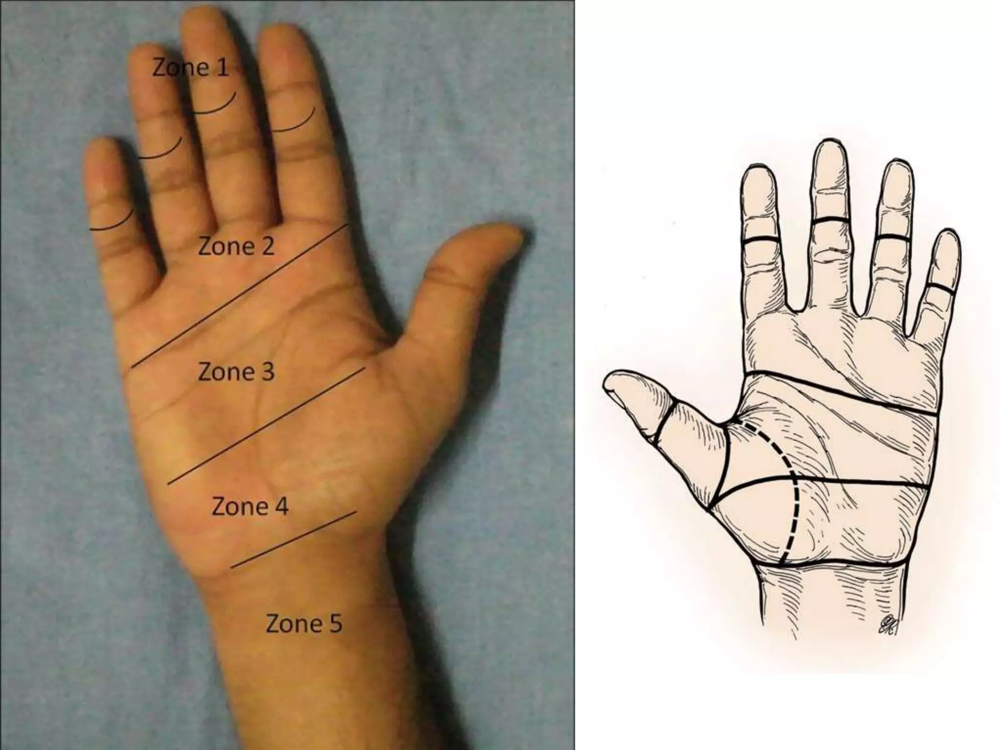 Flexor tendon repair | PPTX