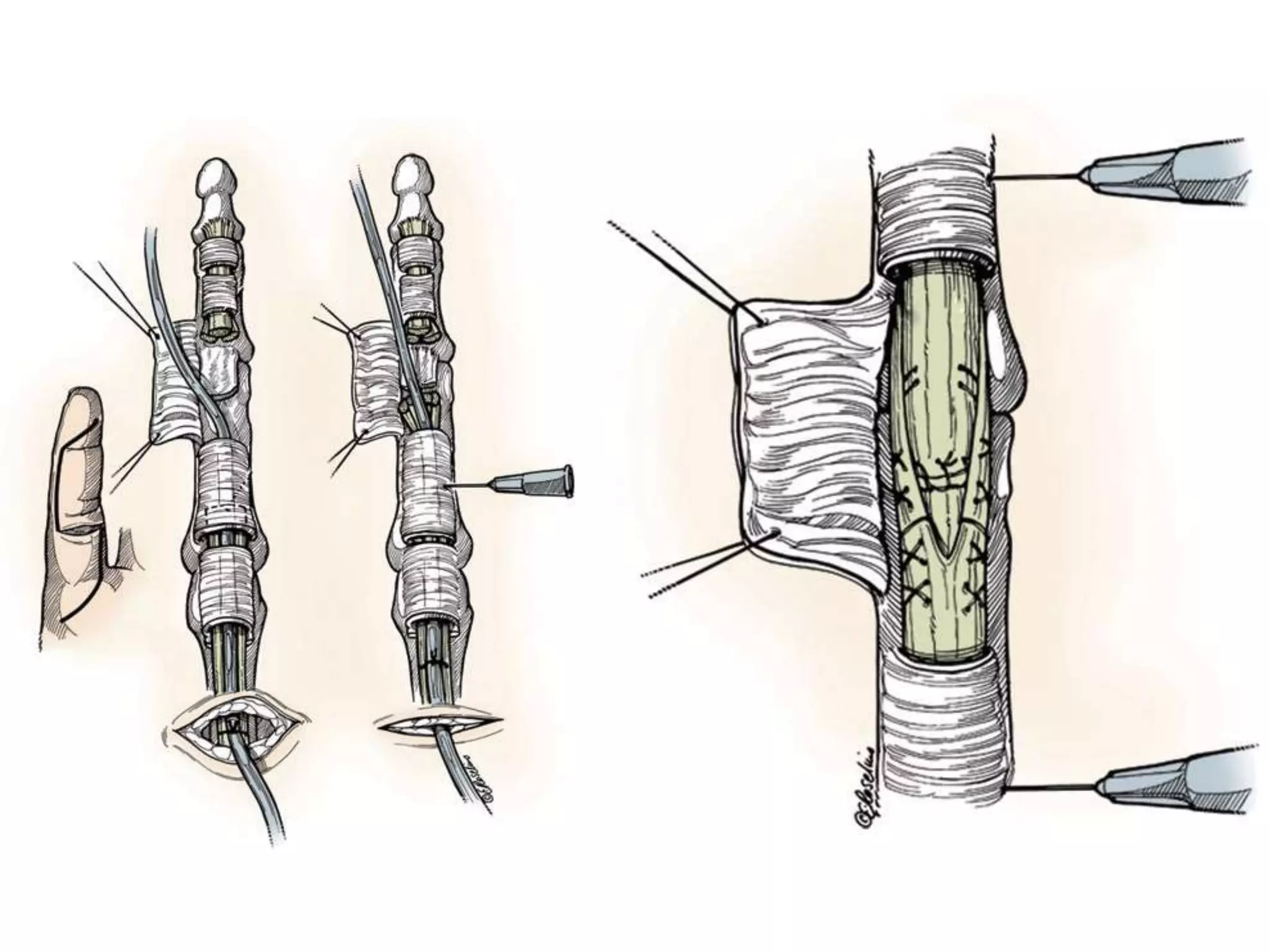 Flexor tendon repair | PPTX