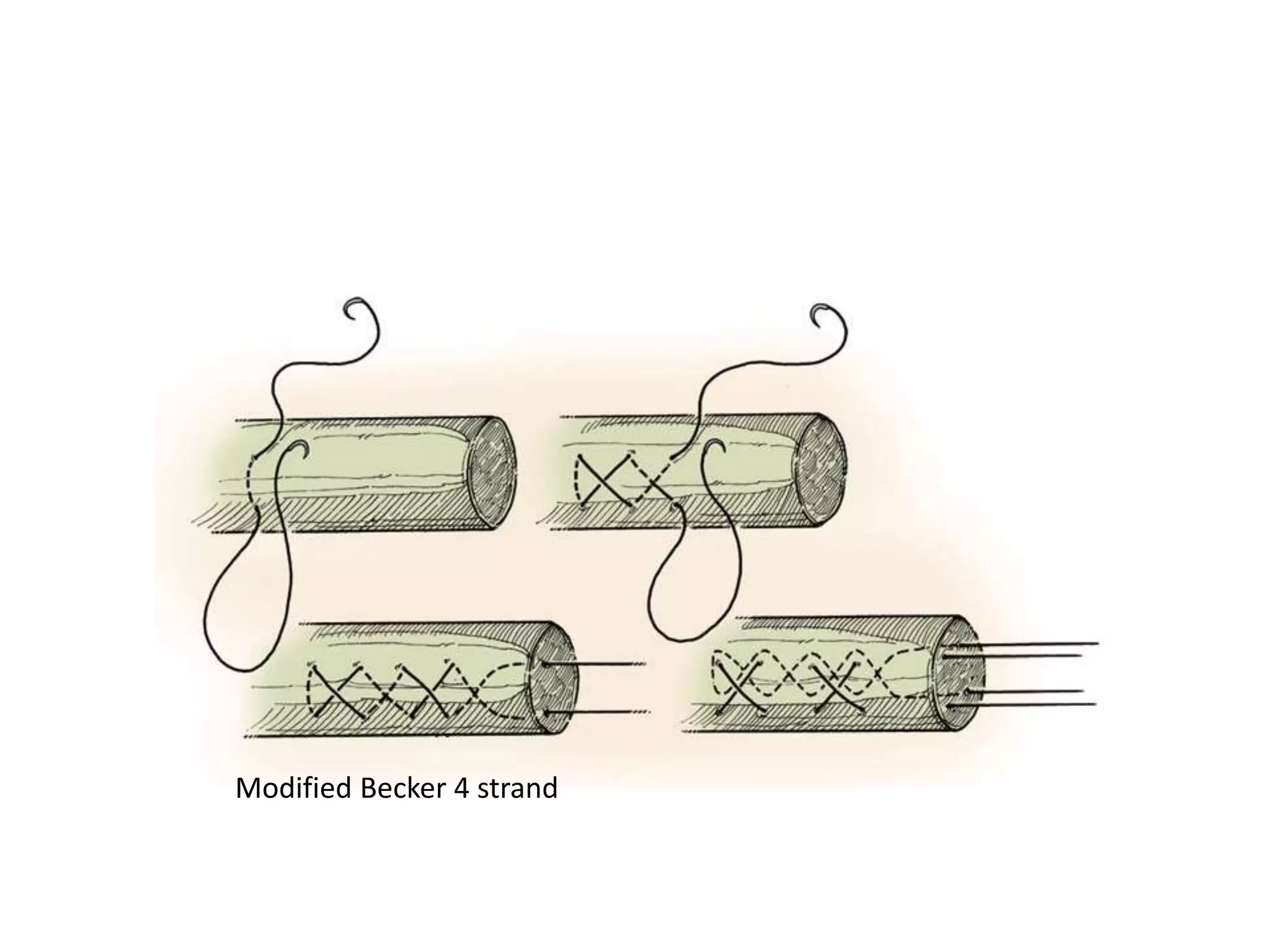 Flexor tendon repair | PPTX