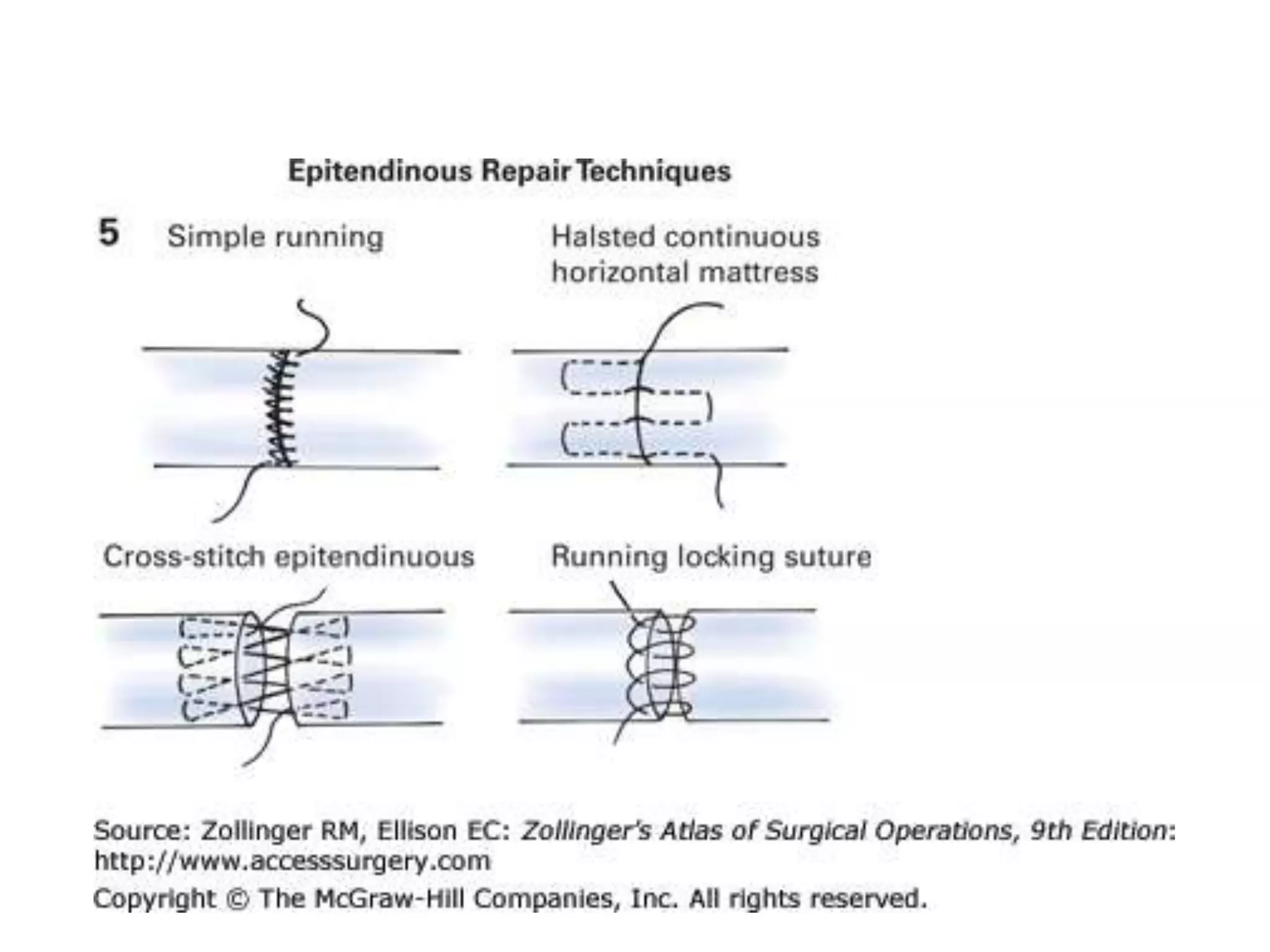 Flexor tendon repair | PPTX