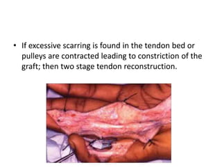 Flexor tendon repair | PPTX