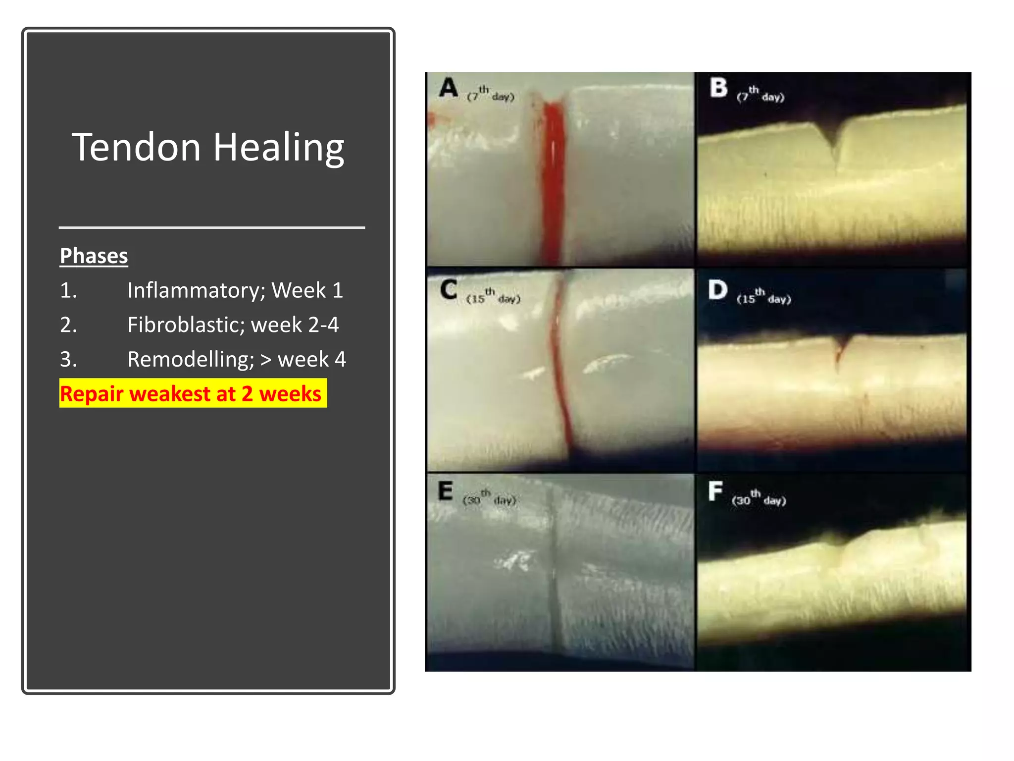 Flexor tendon surgery Review | PPTX