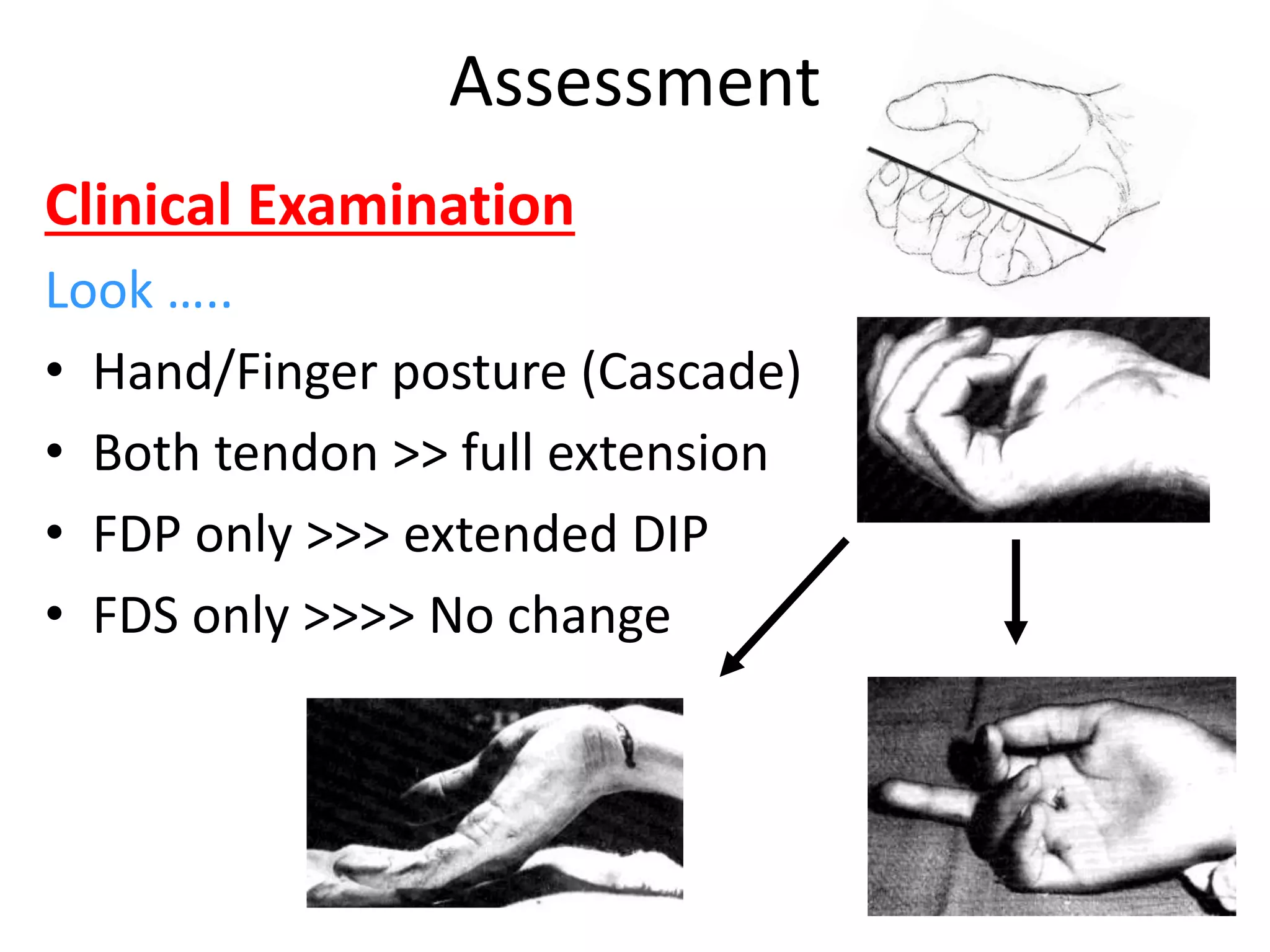 Flexor tendon surgery Review | PPTX