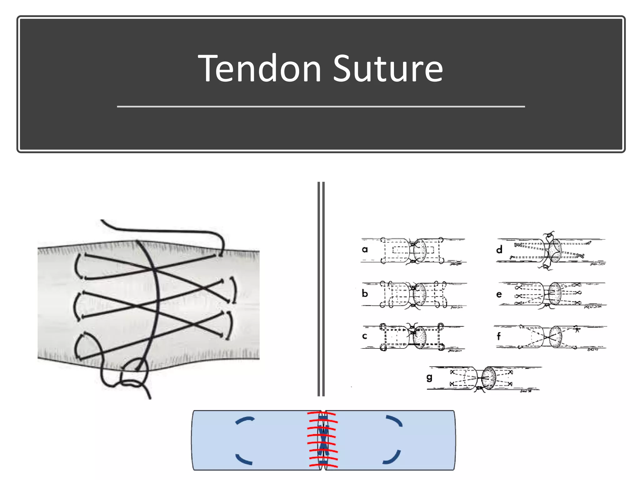 Flexor tendon surgery Review | PPTX