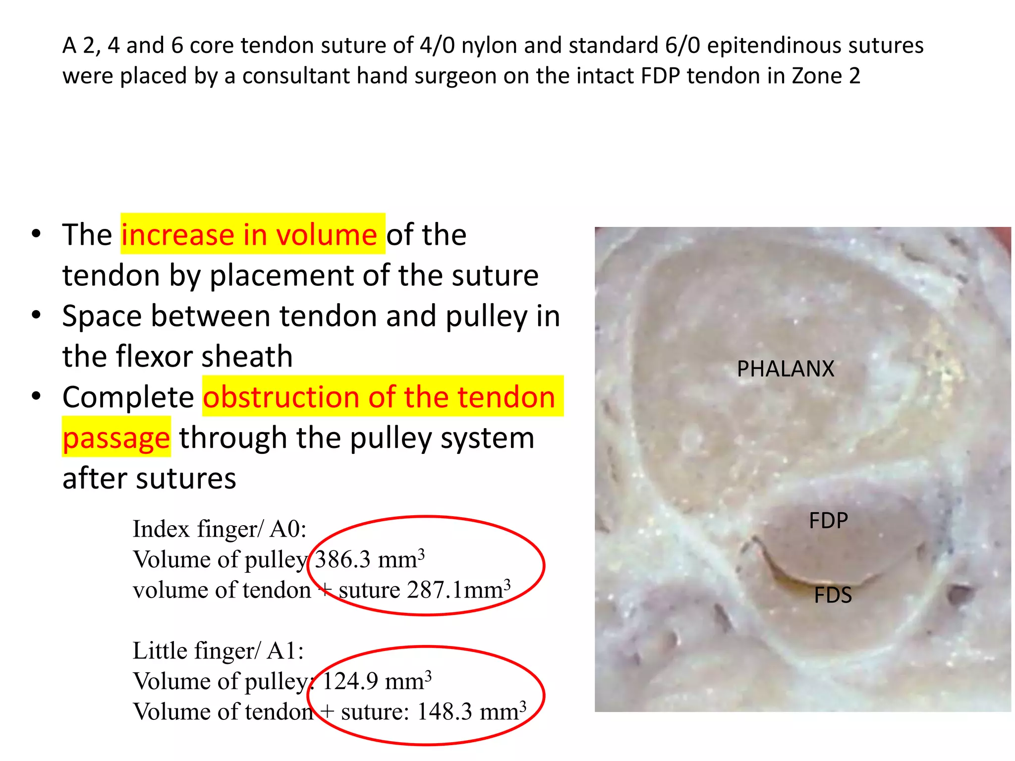 Flexor tendon surgery Review | PPTX
