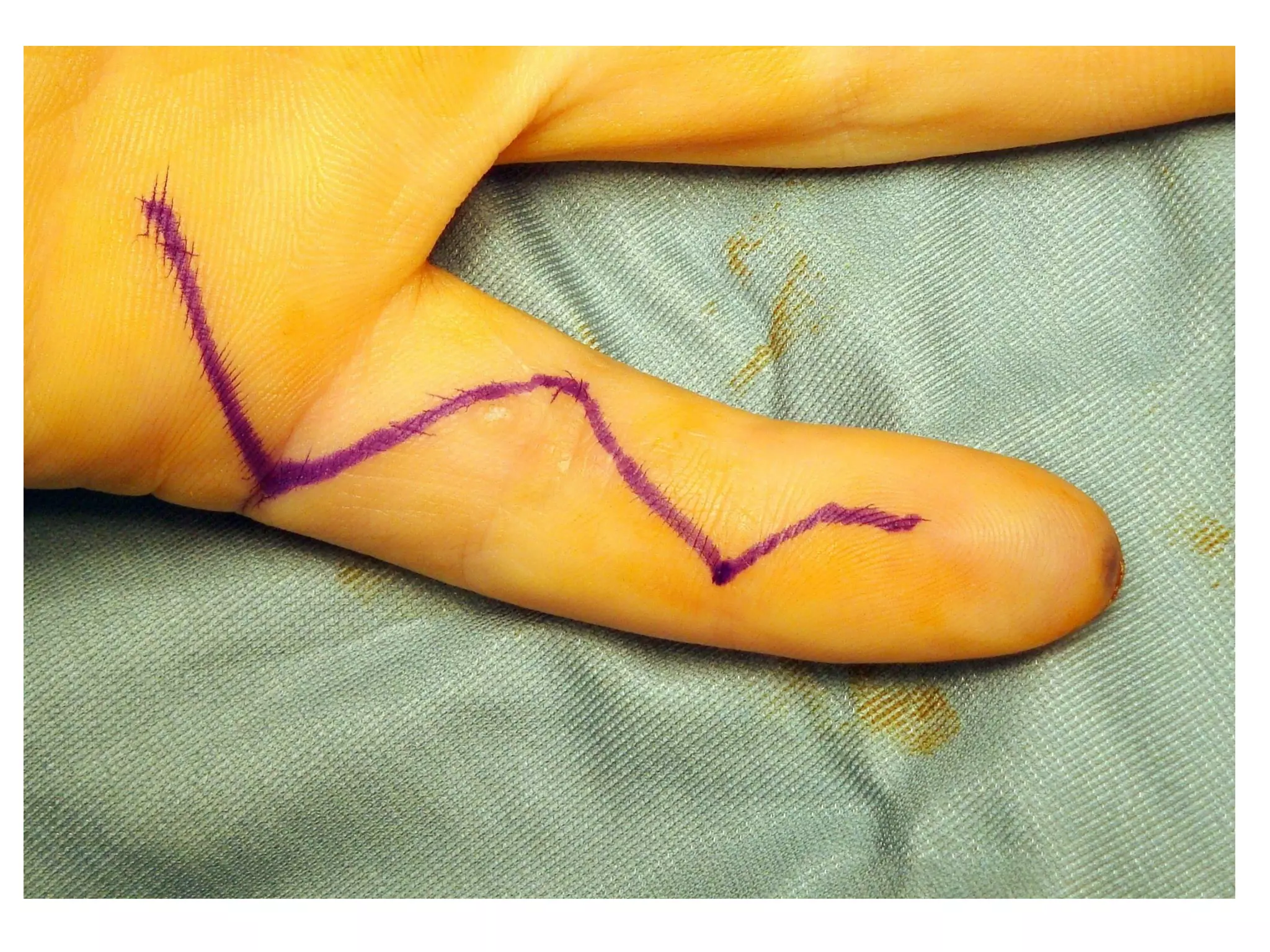 Flexor tendon surgery | PPT