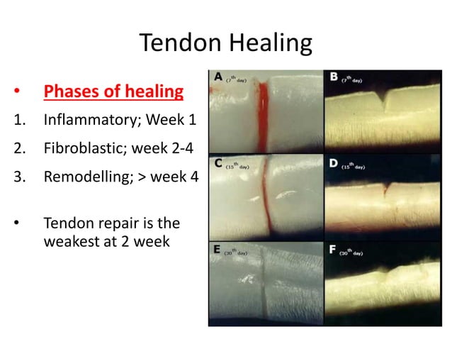Flexor tendon surgery | PPT