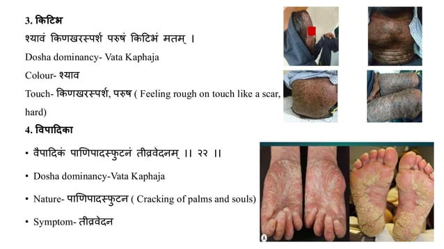 Importance of Shodana in Kushta chikitsa-An ayurvedic view | PDF