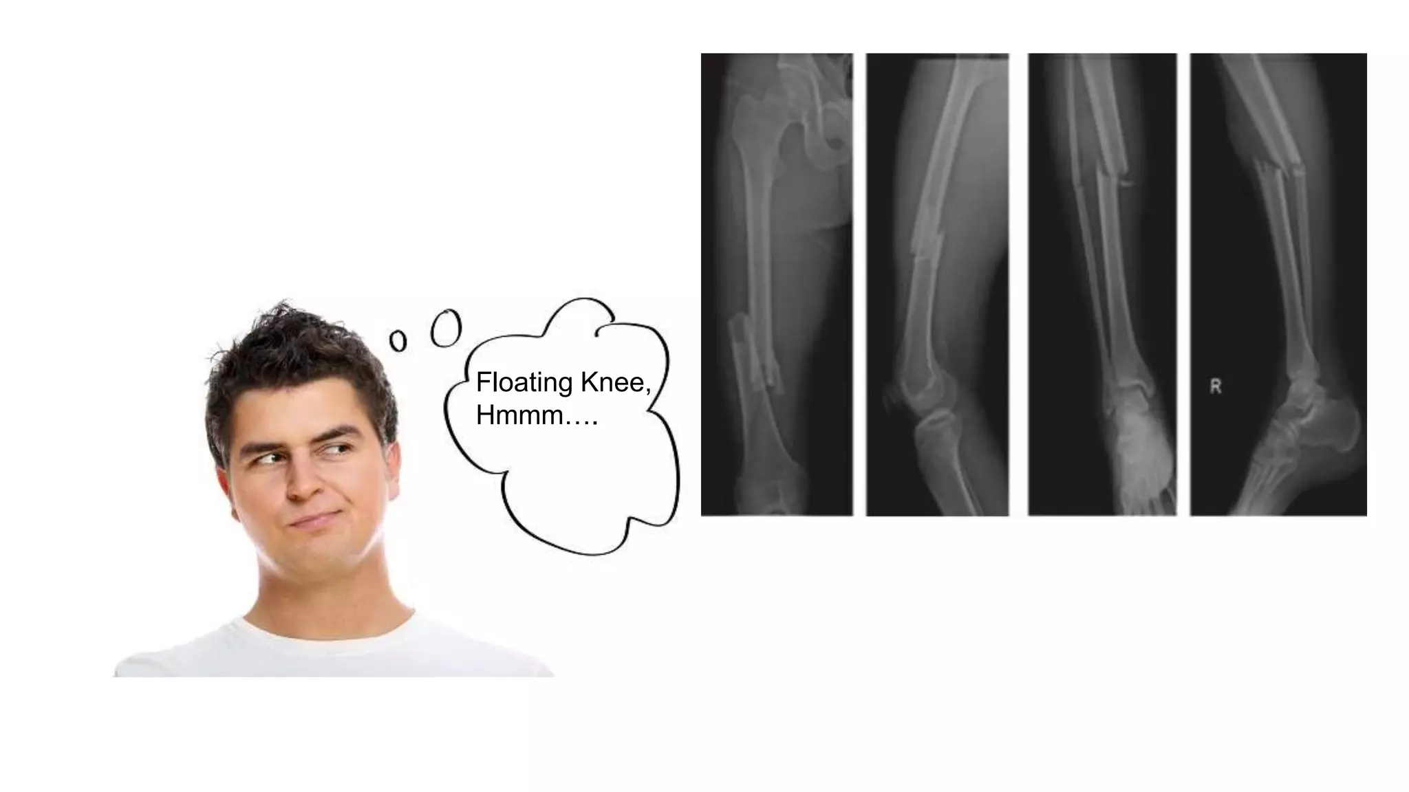 Floating knee injuries | PPTX
