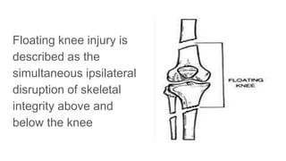 Floating knee injuries | PPTX