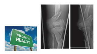 Floating knee injuries | PPTX