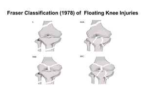 Floating knee injuries | PPTX