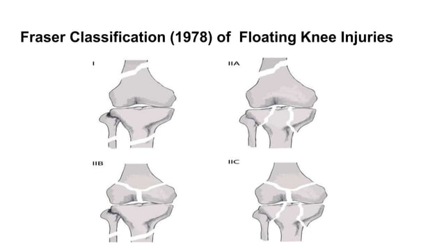 Floating knee injuries | PPTX