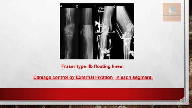 Floating knee | PPTX
