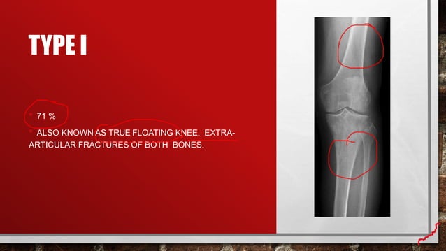 Floating knee | PPTX