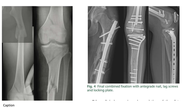 floating knee on Lower Limb trauma orthopedics.pptx | Death, Injury, or ...
