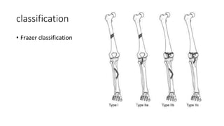 floating knee on Lower Limb trauma orthopedics.pptx