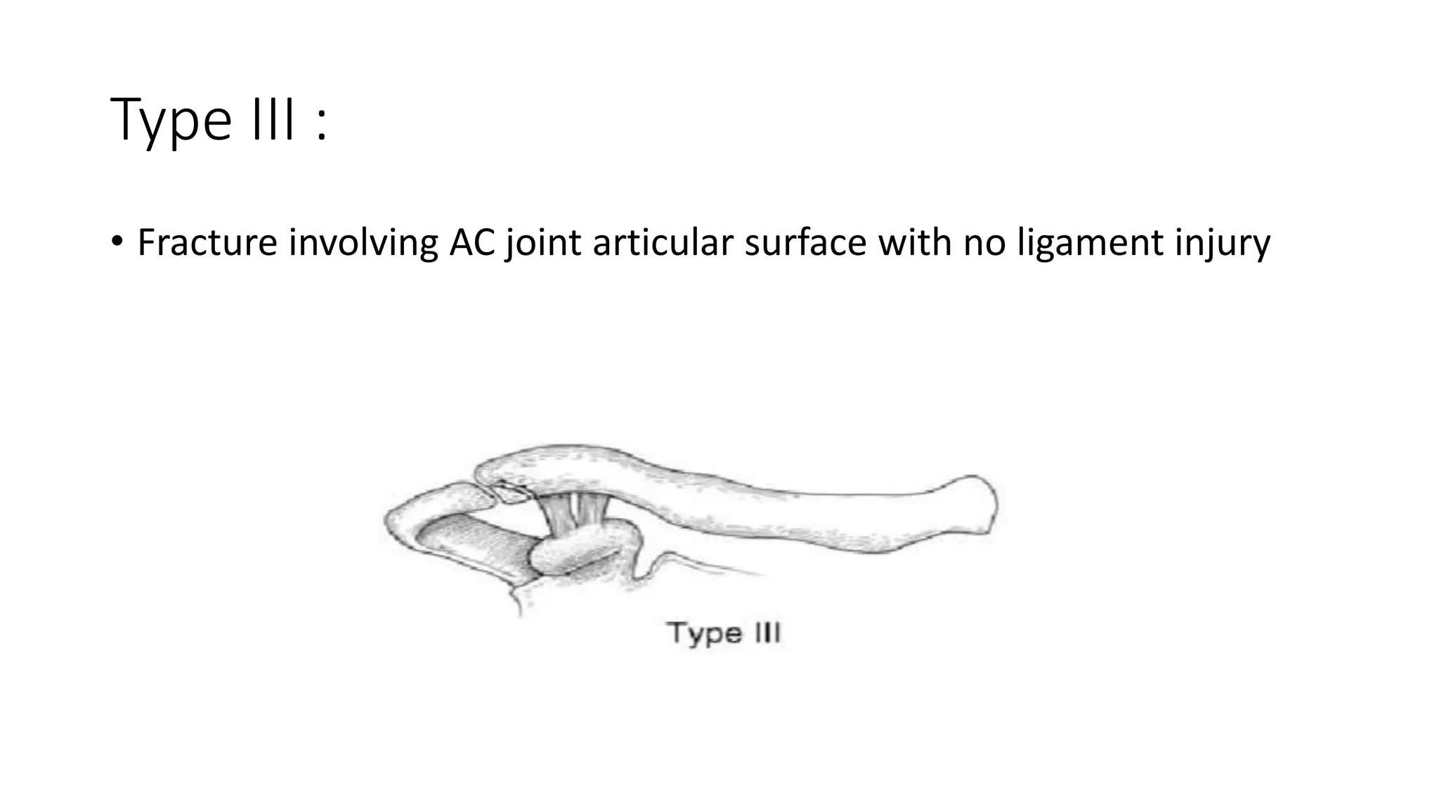 floating shoulder ppt-3.pptx Dr Ashish pargaie Orthopaedic resident ...