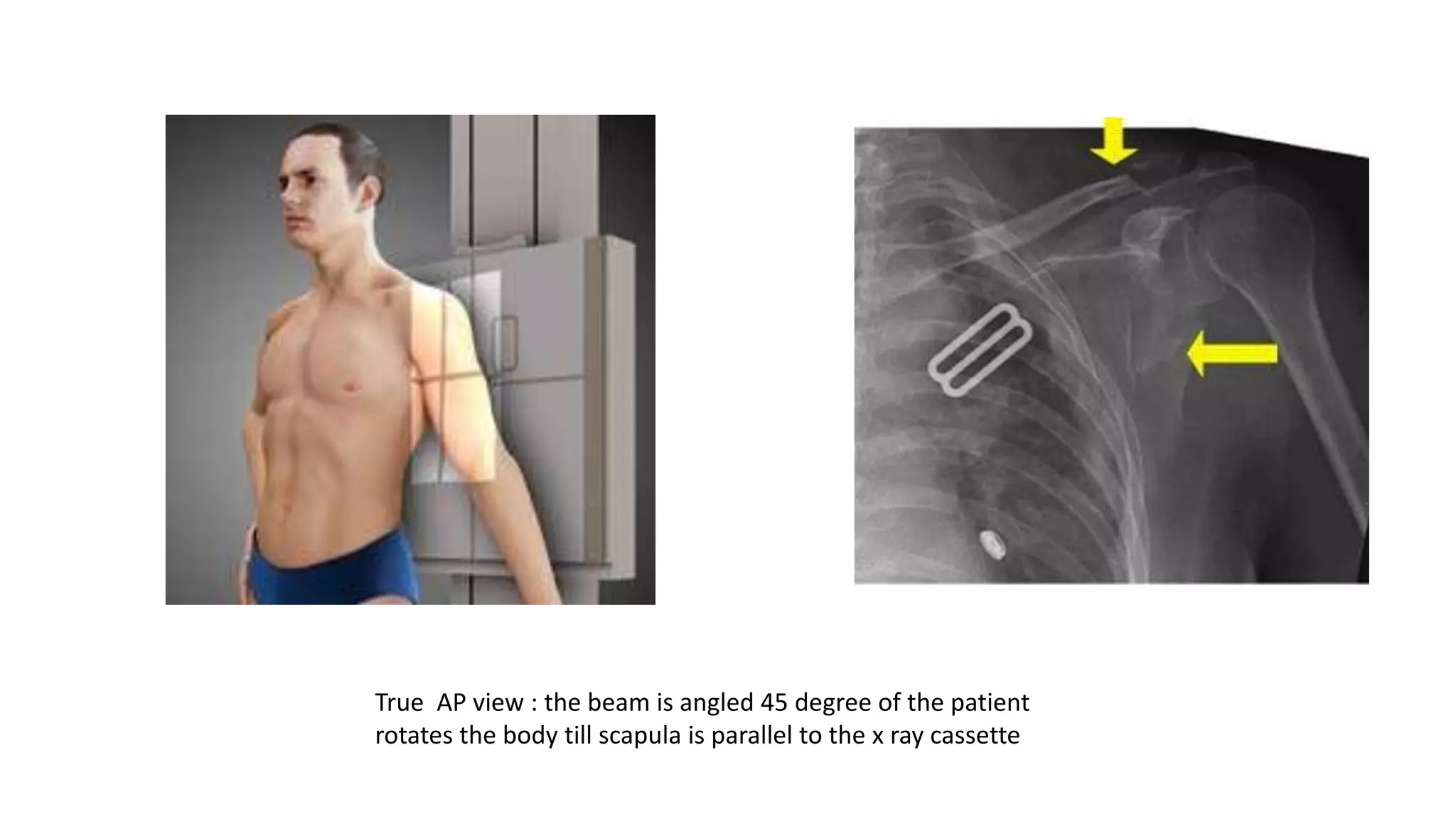 floating shoulder ppt-3.pptx Dr Ashish pargaie Orthopaedic resident ...