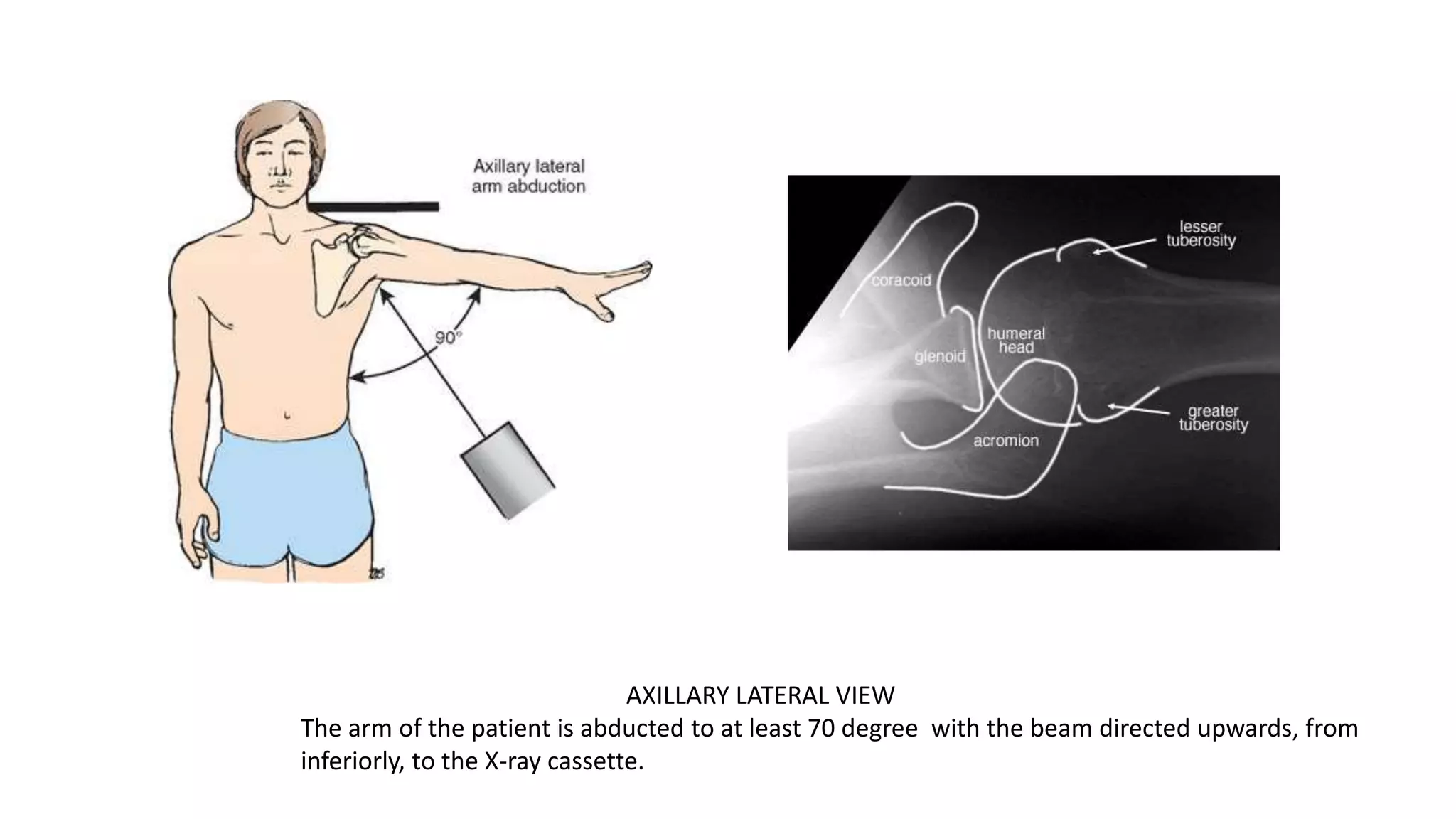 floating shoulder ppt-3.pptx Dr Ashish pargaie Orthopaedic resident ...