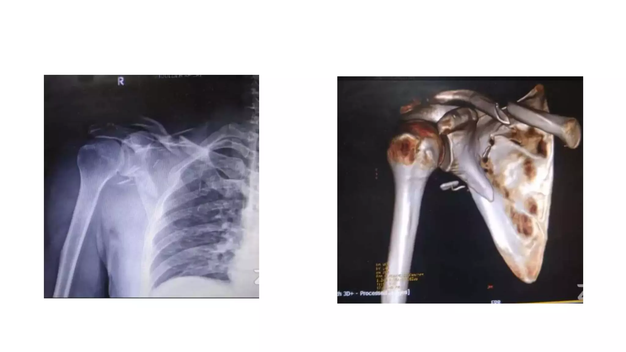 floating shoulder ppt-3.pptx Dr Ashish pargaie Orthopaedic resident ...