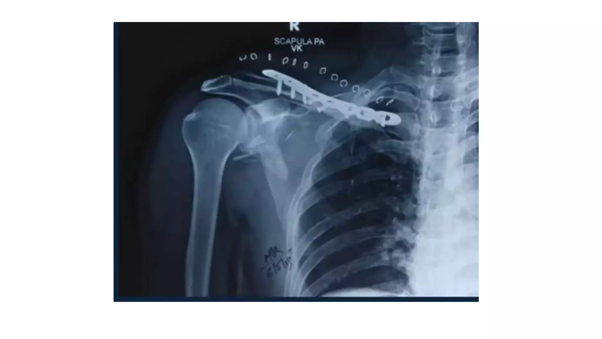 floating shoulder ppt-3.pptx Dr Ashish pargaie Orthopaedic resident ...