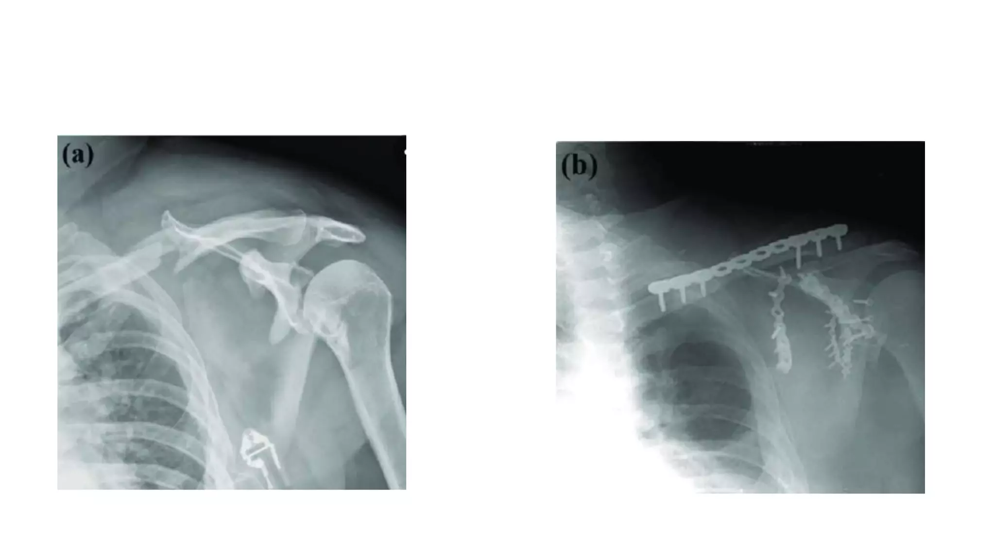 floating shoulder ppt-3.pptx Dr Ashish pargaie Orthopaedic resident ...
