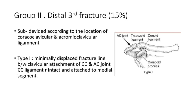 floating shoulder ppt-3.pptx Dr Ashish pargaie Orthopaedic resident ...