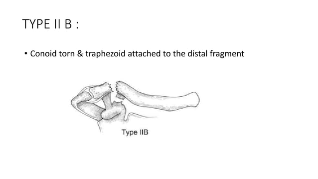 floating shoulder ppt-3.pptx Dr Ashish pargaie Orthopaedic resident ...