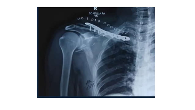 floating shoulder ppt-3.pptx Dr Ashish pargaie Orthopaedic resident ...
