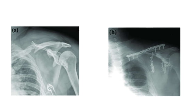 floating shoulder ppt-3.pptx Dr Ashish pargaie Orthopaedic resident ...