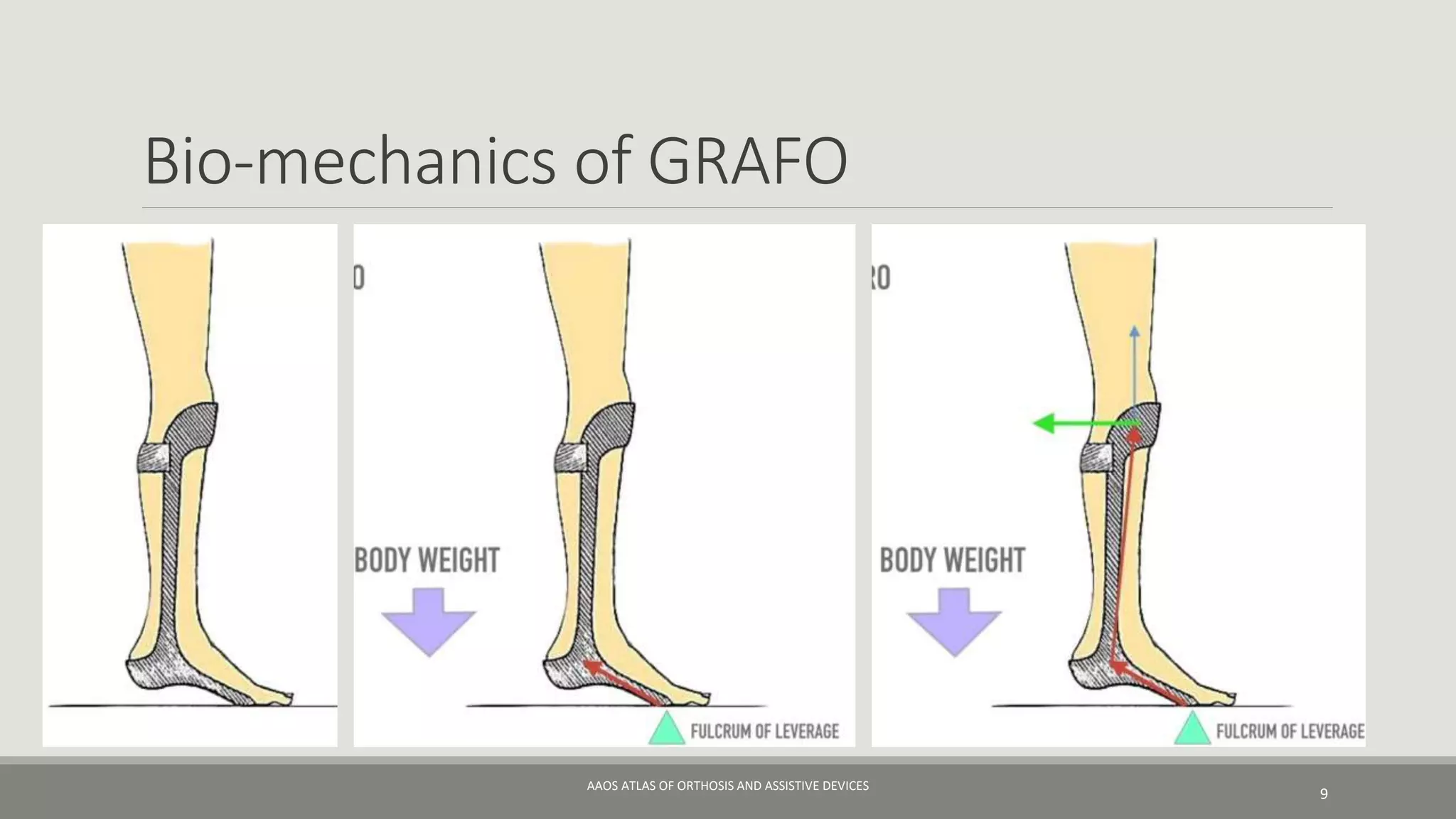 Floor reaction Ankle foot orthosis or Gravity reaction ankle foot ...