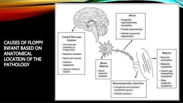 approach to a floppy infant