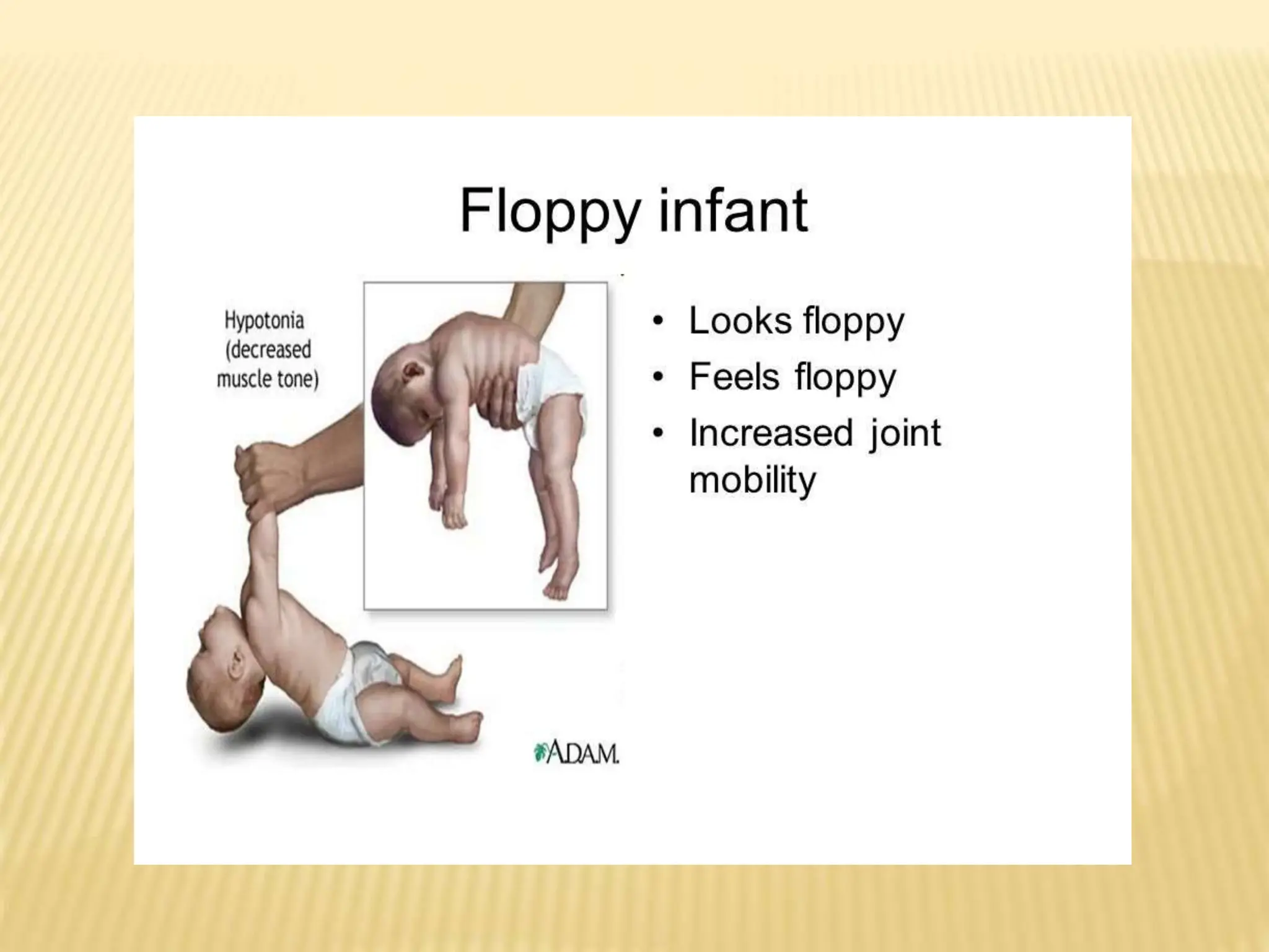 Approach to a child with hypotonia.pptx