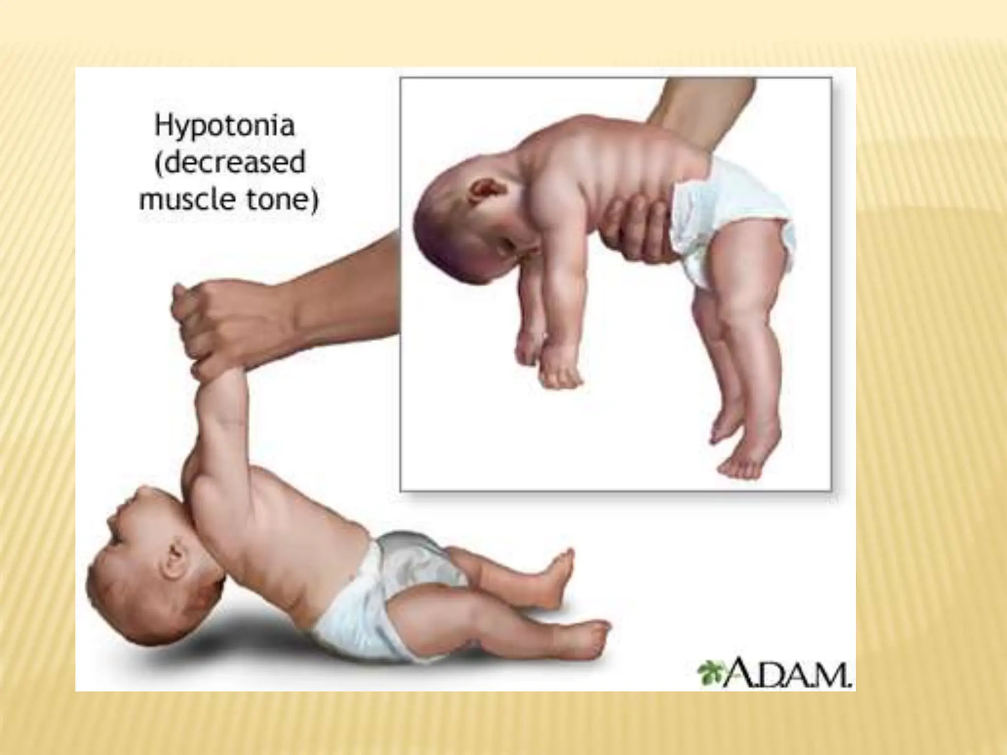 Approach to a child with hypotonia.pptx