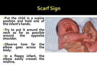Floppy infant | PDF