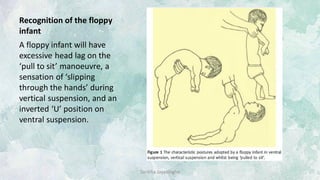 Floppy infant- Dr. Sankha Jayasinghe | PDF