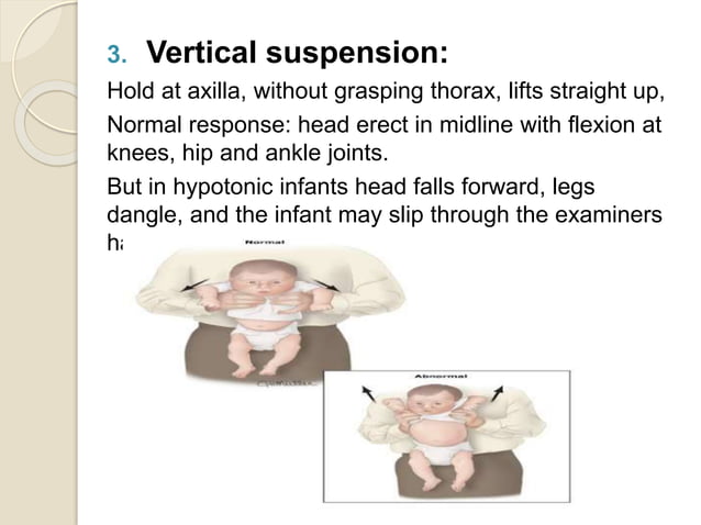 floppy infant.pptx | Pregnancy | Reproductive Health