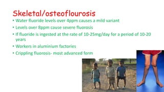 FLOURIDE TOXICITY IN DENTISTRY .pptx