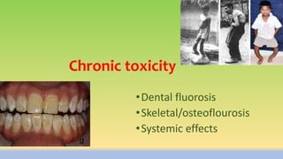 FLOURIDE TOXICITY IN DENTISTRY .pptx