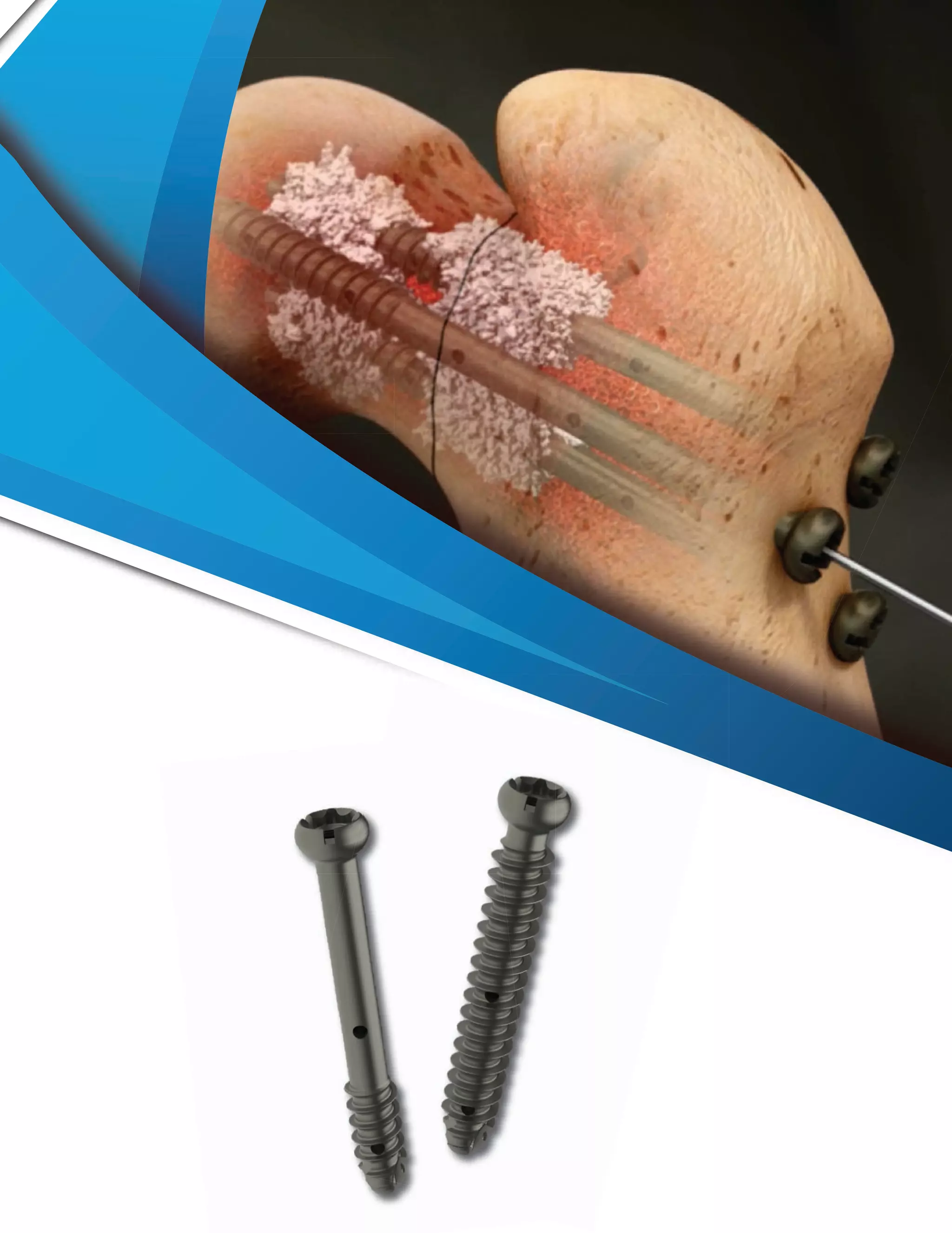 Flow-FX Flow Screw ~ Surgical Technique Guide | PDF