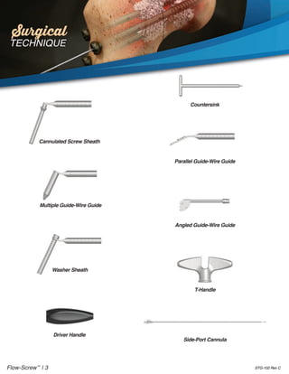 Flow-FX Flow Screw ~ Surgical Technique Guide | PDF