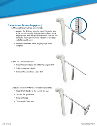 Flow-FX Flow Screw ~ Surgical Technique Guide | PDF