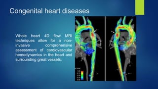 4D FLOW MRI | PPTX