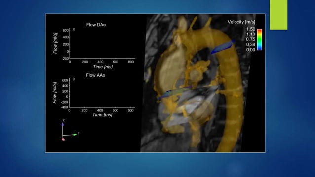 4D FLOW MRI | PPTX | Heart and Cardiovascular Diseases | Diseases and ...