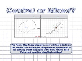 Flow volume loop quick loop guide | PPT